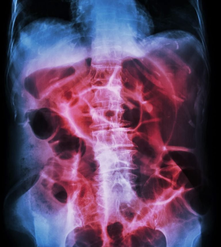 The Hidden Danger: Uncovering the Impact of Small Bowel Obstruction ...